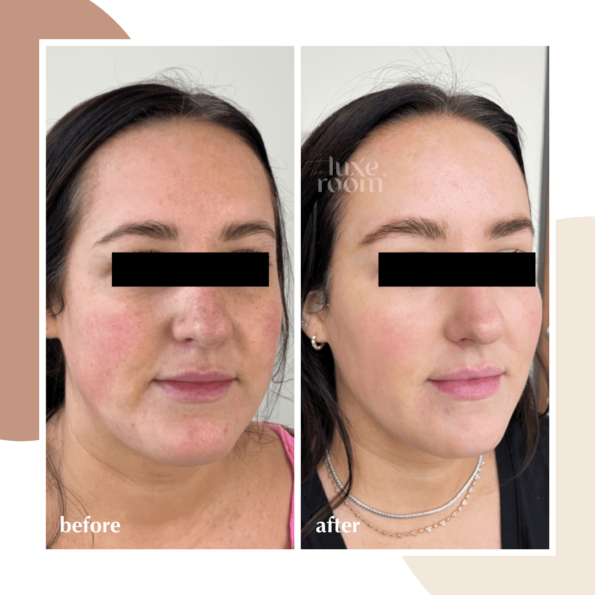 Denver Botox - Boulder Botox - Best Medspa | Lip Filler, Injectables