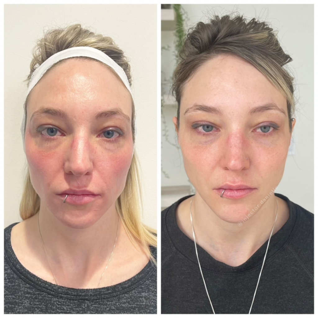 Sculptra in Denver, Boulder & Fort Collins | Best Sculptra Injectors in ...