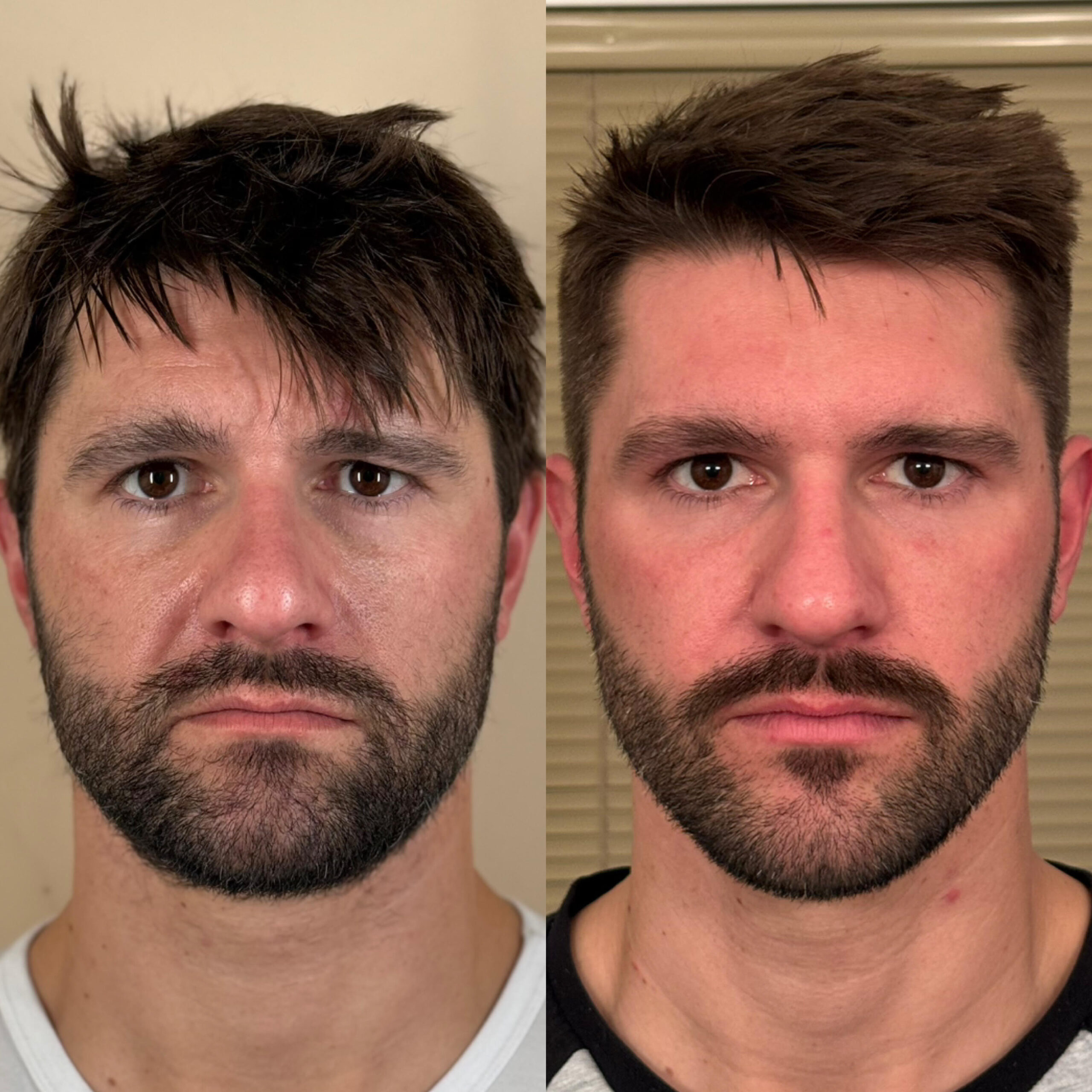 Botox for Men: The Trend That's Becoming the Norm - The Luxe Room
