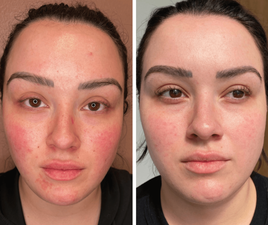 Moxi Laser – The No-Downtime Way to Renew Your Skin - The Luxe Room